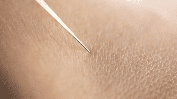 The Ultimate Guide To Dry Needling - All Your Questions Answered